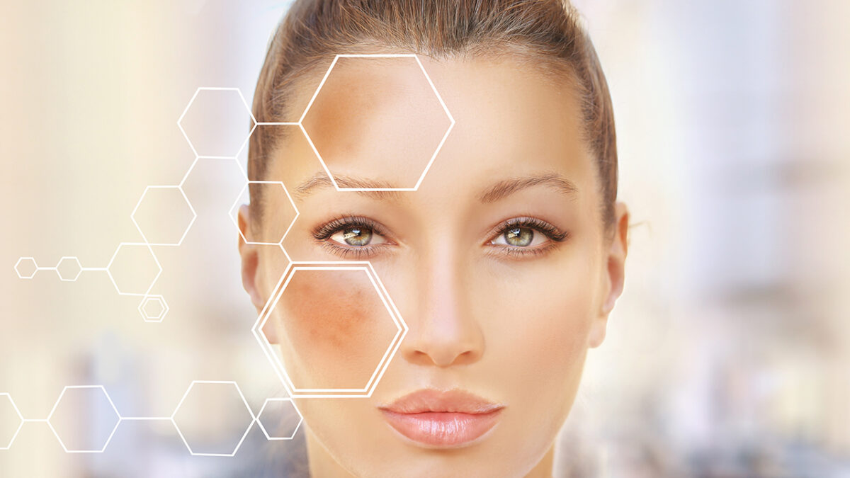 Macchie cutanee senili o lentigo solari: come eliminarle?